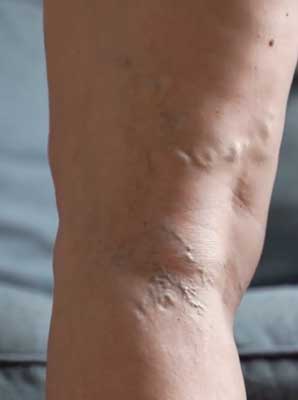 Avoir des varices : pourquoi et quoi faire ? - Paris Veine Institut